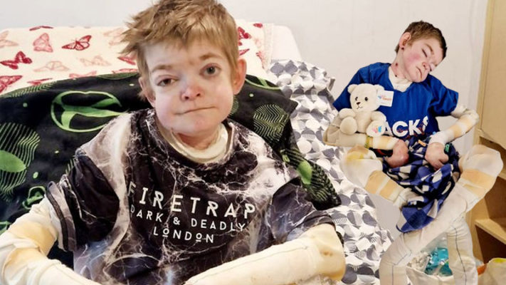 Teenager with Rare 'Butterfly Skin' Disease Faces Final Days Due to ...